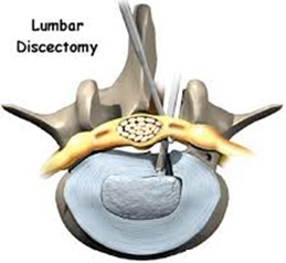 Discectomy - superspecialitycare