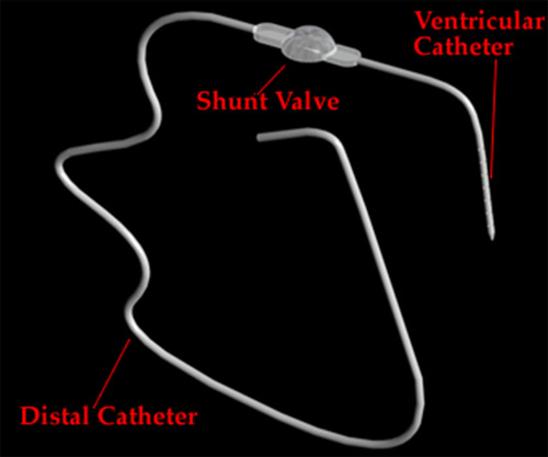 VP Shunt - superspecialitycare