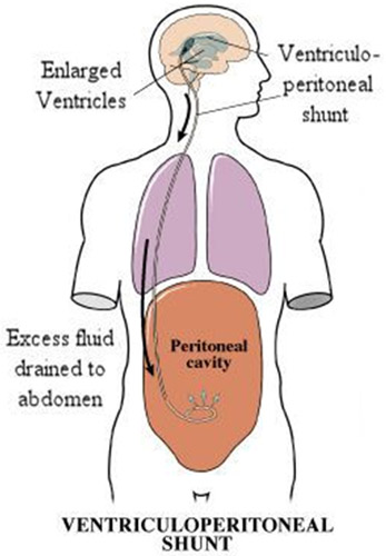 VP Shunt - superspecialitycare