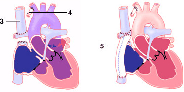BT Shunt & BD Glenn - superspecialitycare
