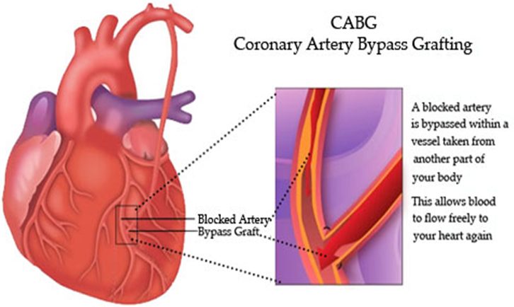 Bypass Surgery - superspecialitycare